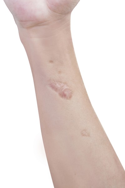 cicatriz atrofica - Dra. Cinthia Orasmo - Dermatologista em Dourados - MS